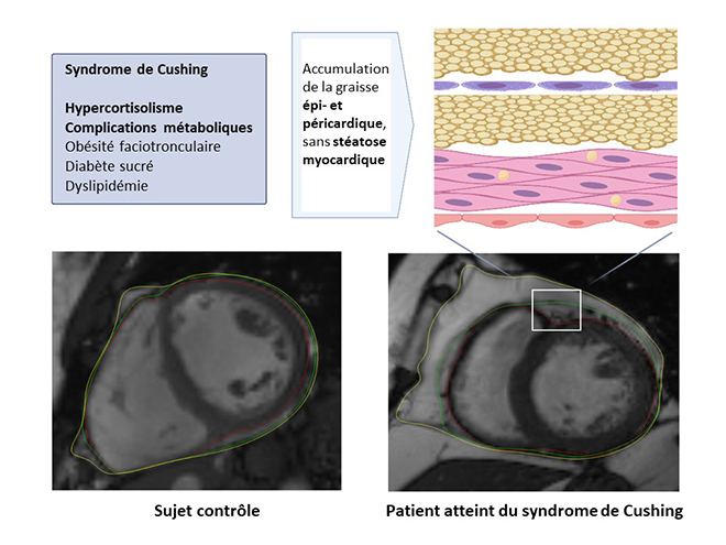 La Lettre de la maladie de Cushing - 02